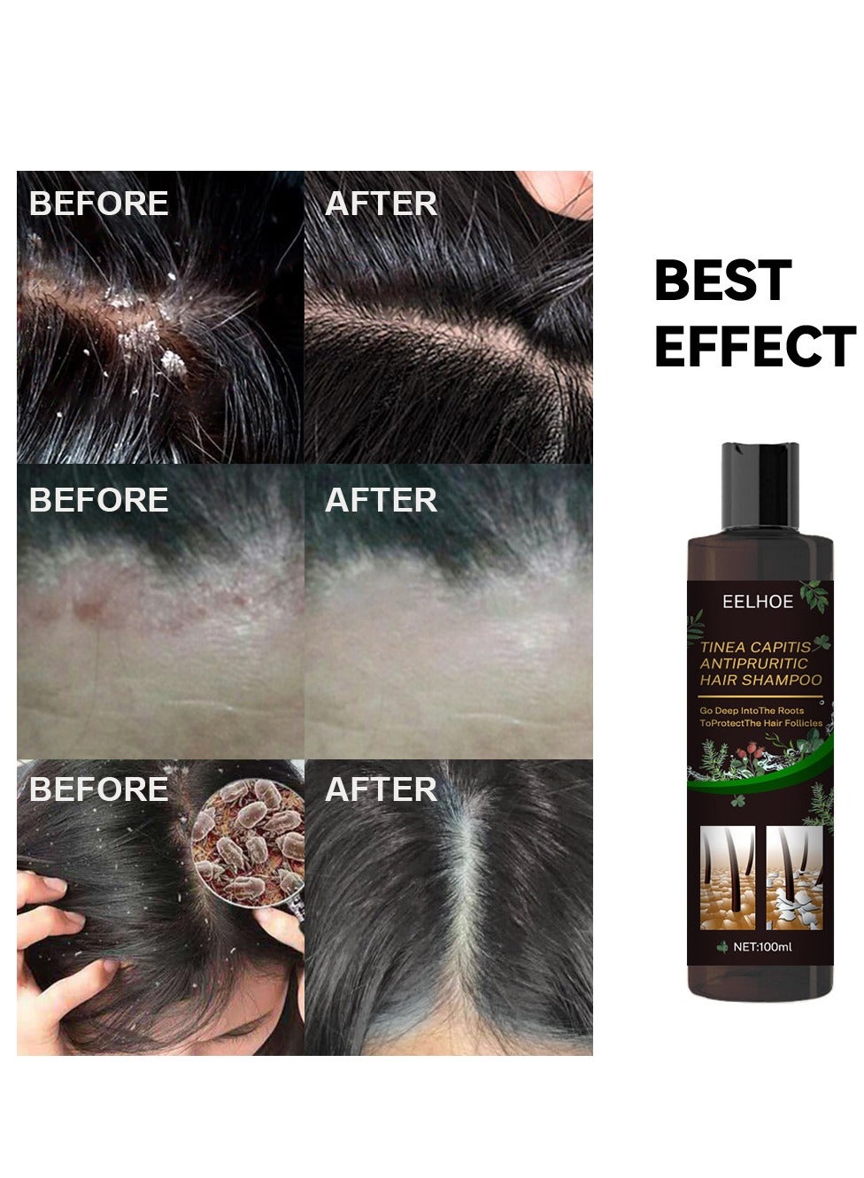 EELHOE Tinea Capitis Antipruritic Hair Shampoo, Anti-Dandruff Shampoo ...