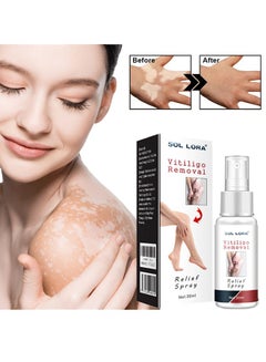 SOL LORA Vitiligo Removal Relief Spray，Promote Melanin Recovery,Reduces White Spots on Skin and ...