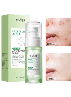 SADOER Salicylic Acid Acne Repair Serum-Salicylic Acid Oil Control Acne Treatment Essence, Anti ...