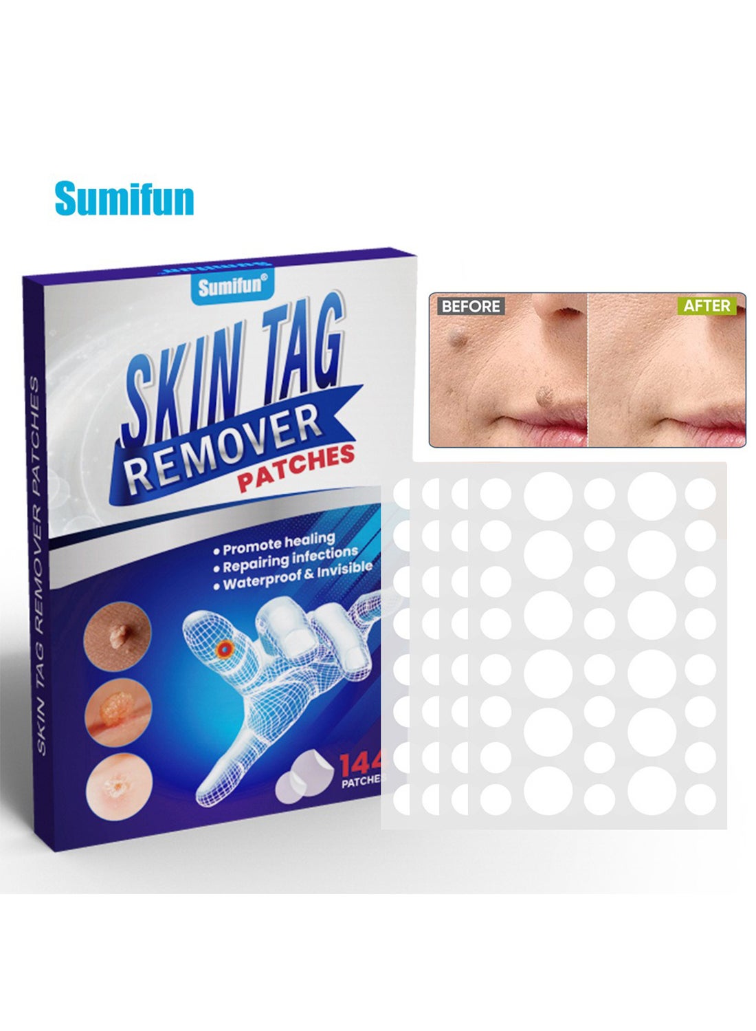 Sumifun Skin Tag Remover Patches, Effective Acne Removal Patches, Fast ...