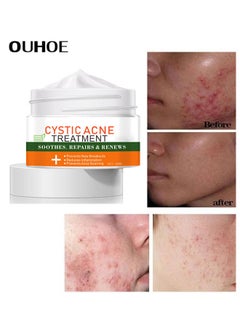 OUHOE Acne Treatment Face Cream, Acne Spot Treatment for Face & Acne ...