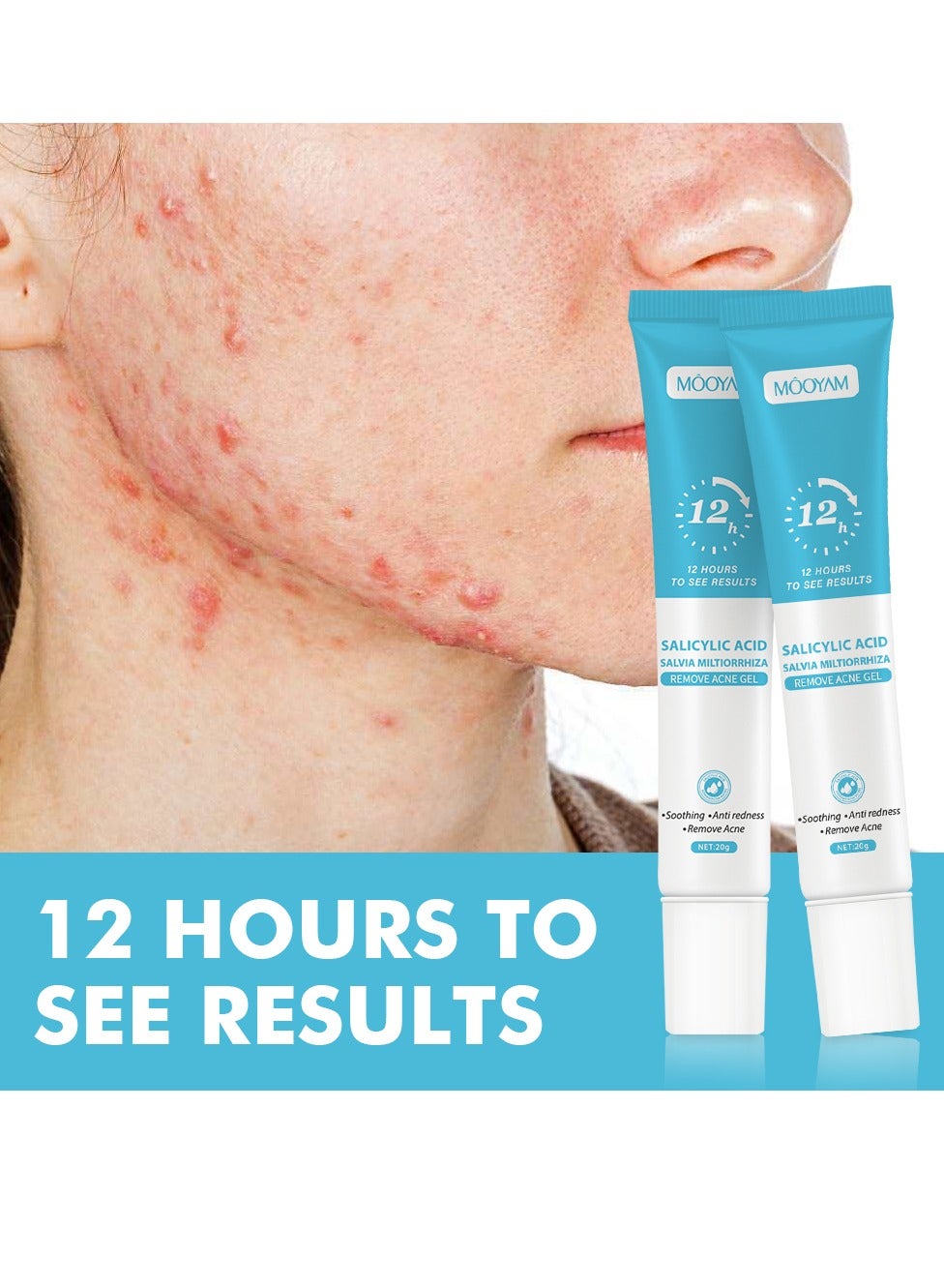 MOOYAM Salicylic Acid Remove Acne Gel 20g, Rapid Action Acne Spot ...