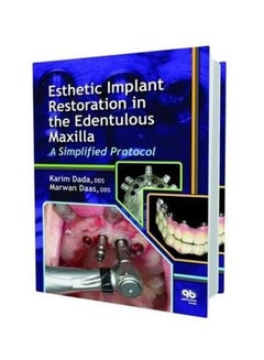 Esthetic Implant Restoration in the Edentulous Maxilla: A Simplified ...
